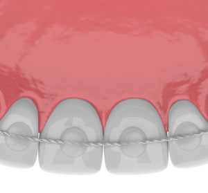 Contention en Orthodontie Dinan - Orthodontiste Dinan